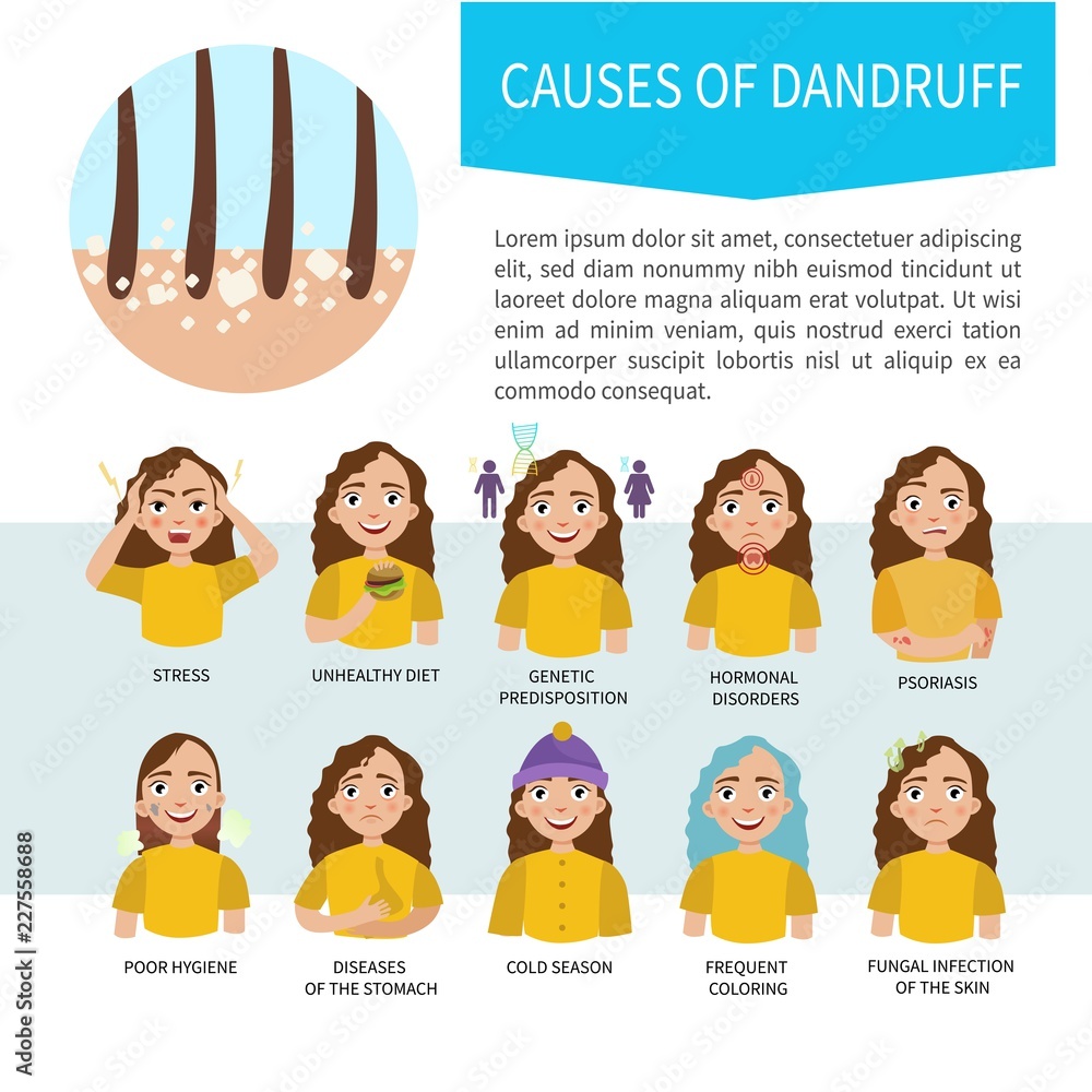 Medical poster causes dandruff. Illustration of a cute girl. Stock ...