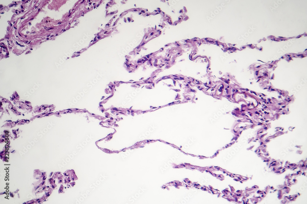 Diffuse lung emphysema, light micrograph, photo under microscope Stock ...
