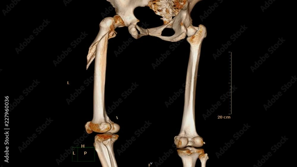 CT Scan of lower limb /pelvis /Hip joint show fracture of left femur ...