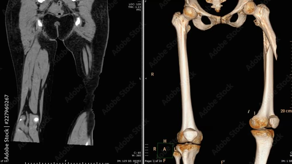 CT Scan of lower limb /pelvis /Hip joint show fracture of left femur ...