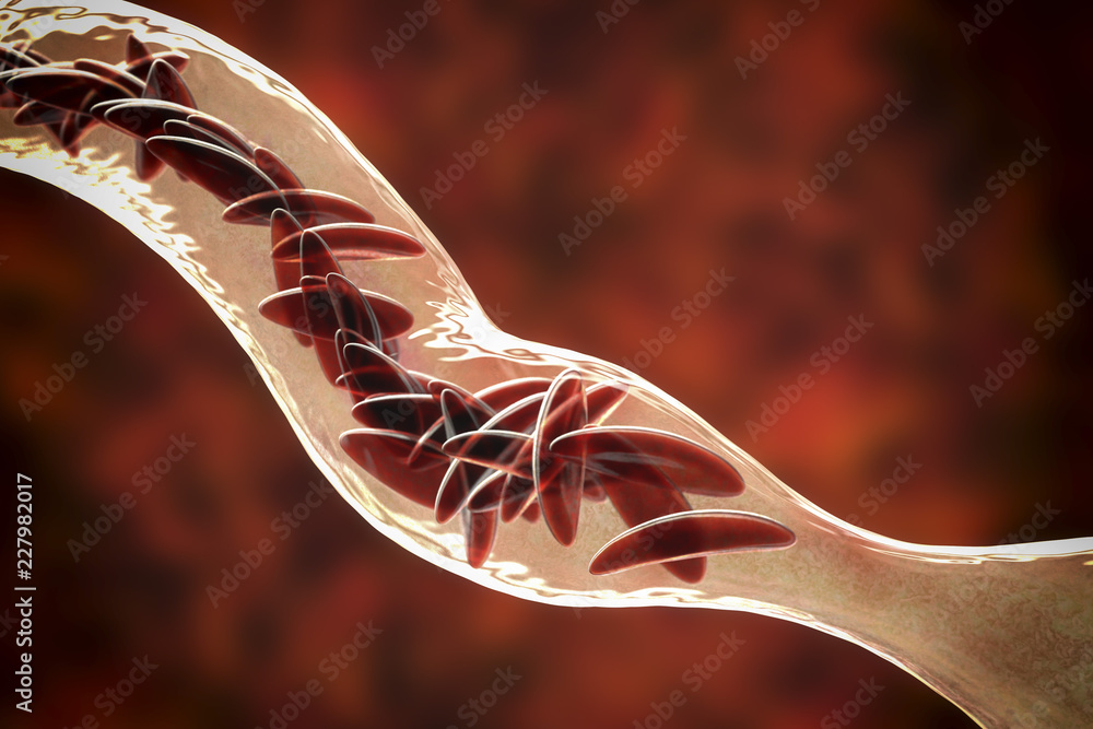 Sickle cell anemia, 3D illustration. Clumps of sickle cell block the ...