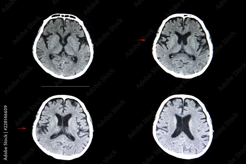 Photo & Art Print brain atrophy and cerebral infarction, SOPONE