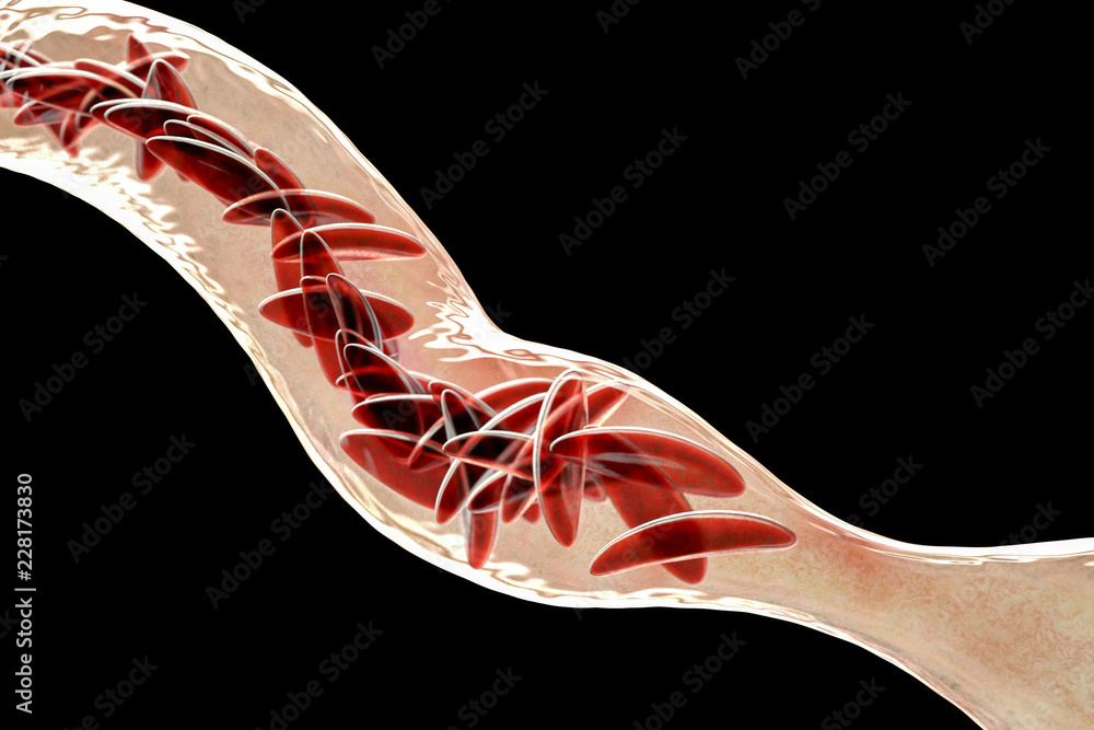 Sickle cell anemia, 3D illustration. Clumps of sickle cell block the ...