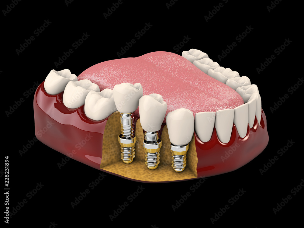 Human teeth and Dental implant. 3d illustration isolated black Stock ...