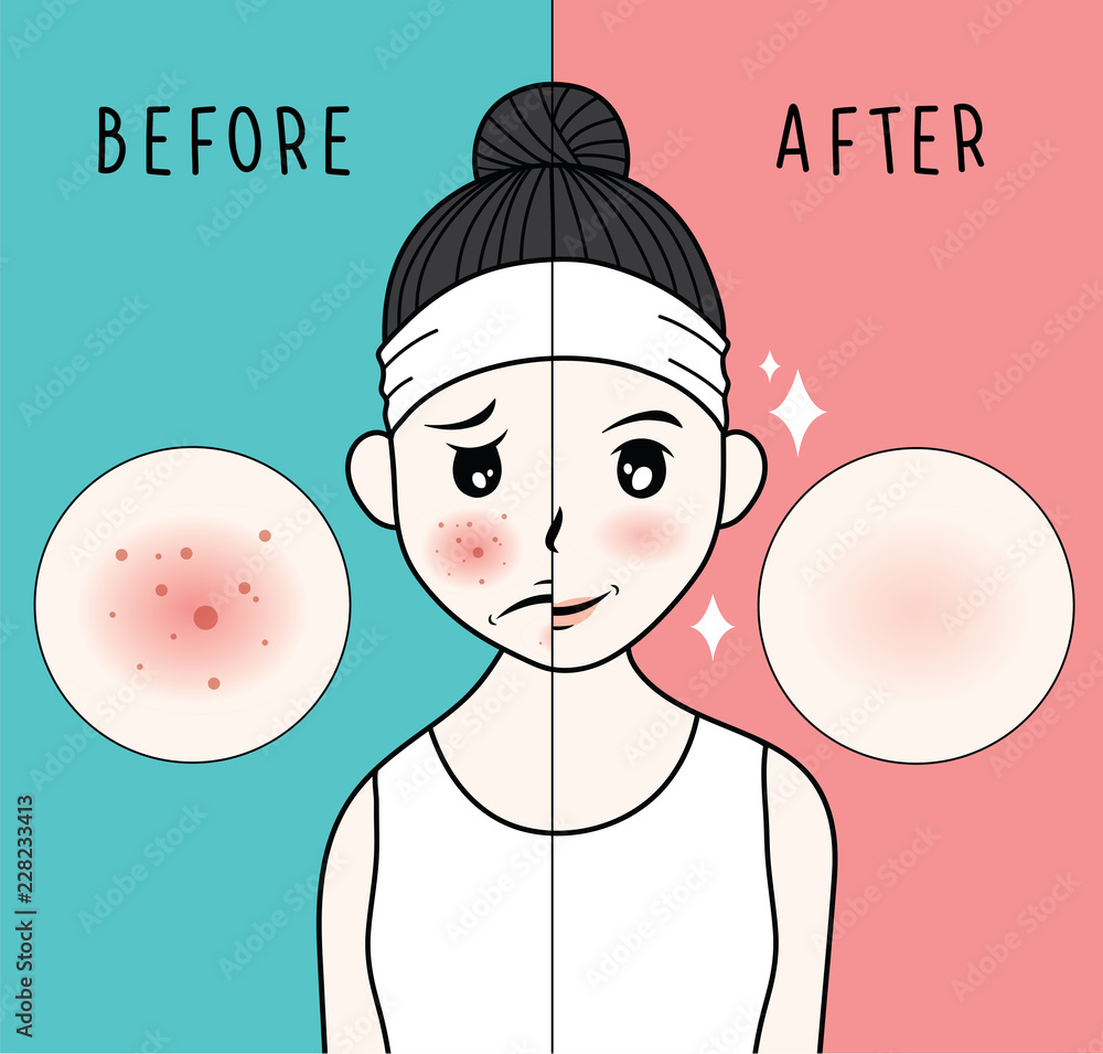 vector woman face. acne before and after. skin care illustration. Stock ...