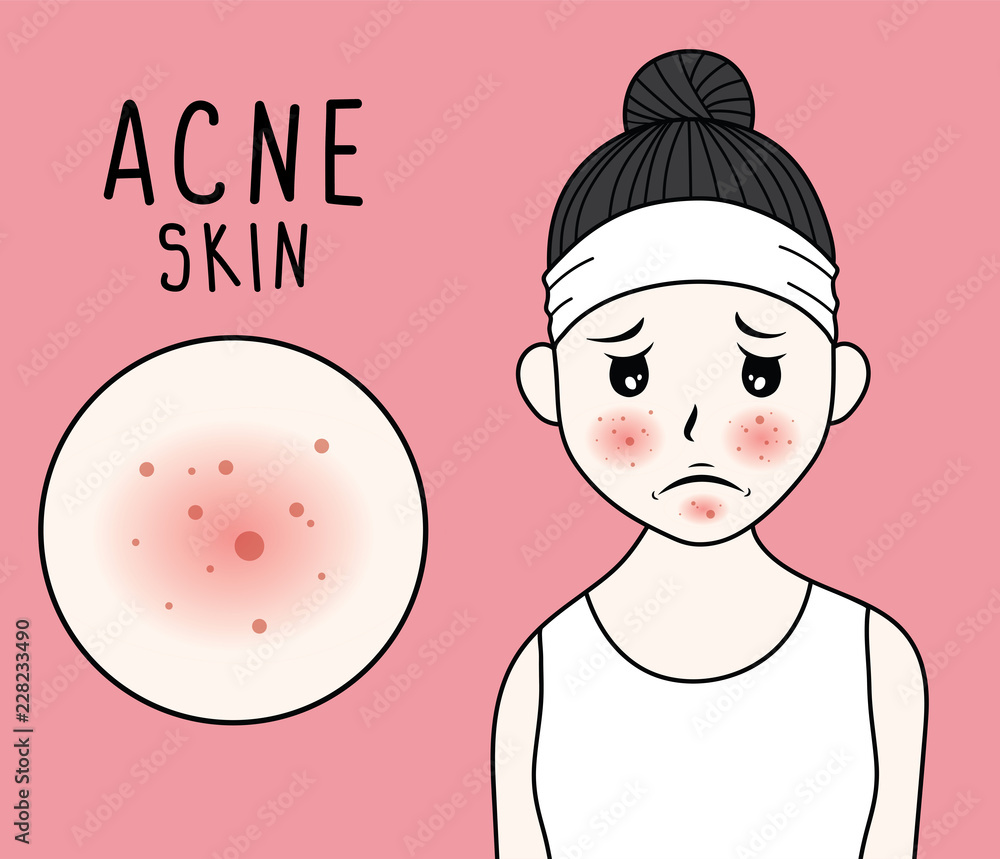 vector woman face. acne before and after. skin care illustration. Stock ...