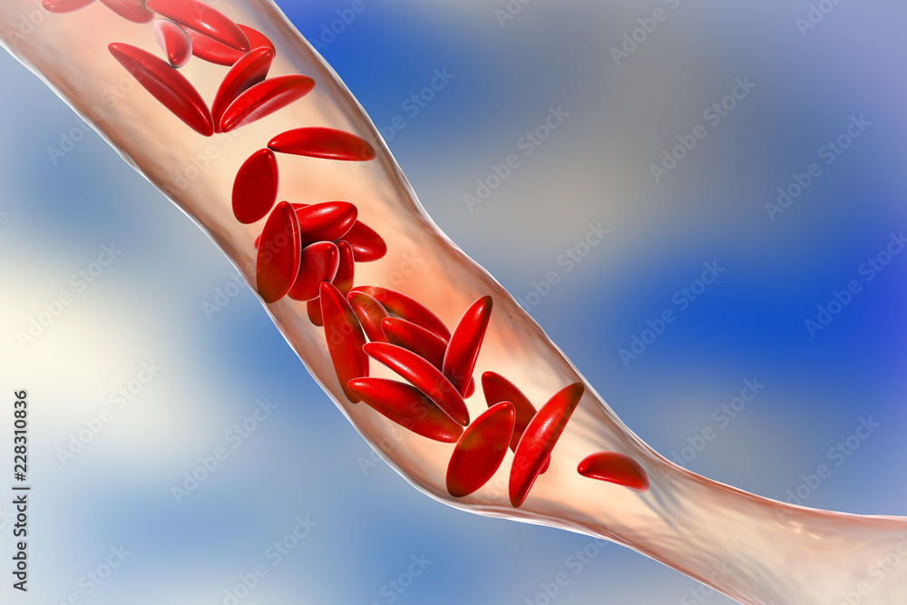 Sickle cell anemia, 3D illustration. Clumps of sickle cell block the ...