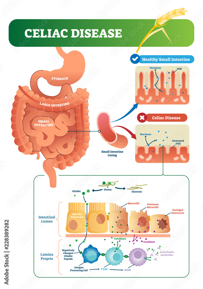 Celiac disease vector illustration. Labeled diagram with its structure ...
