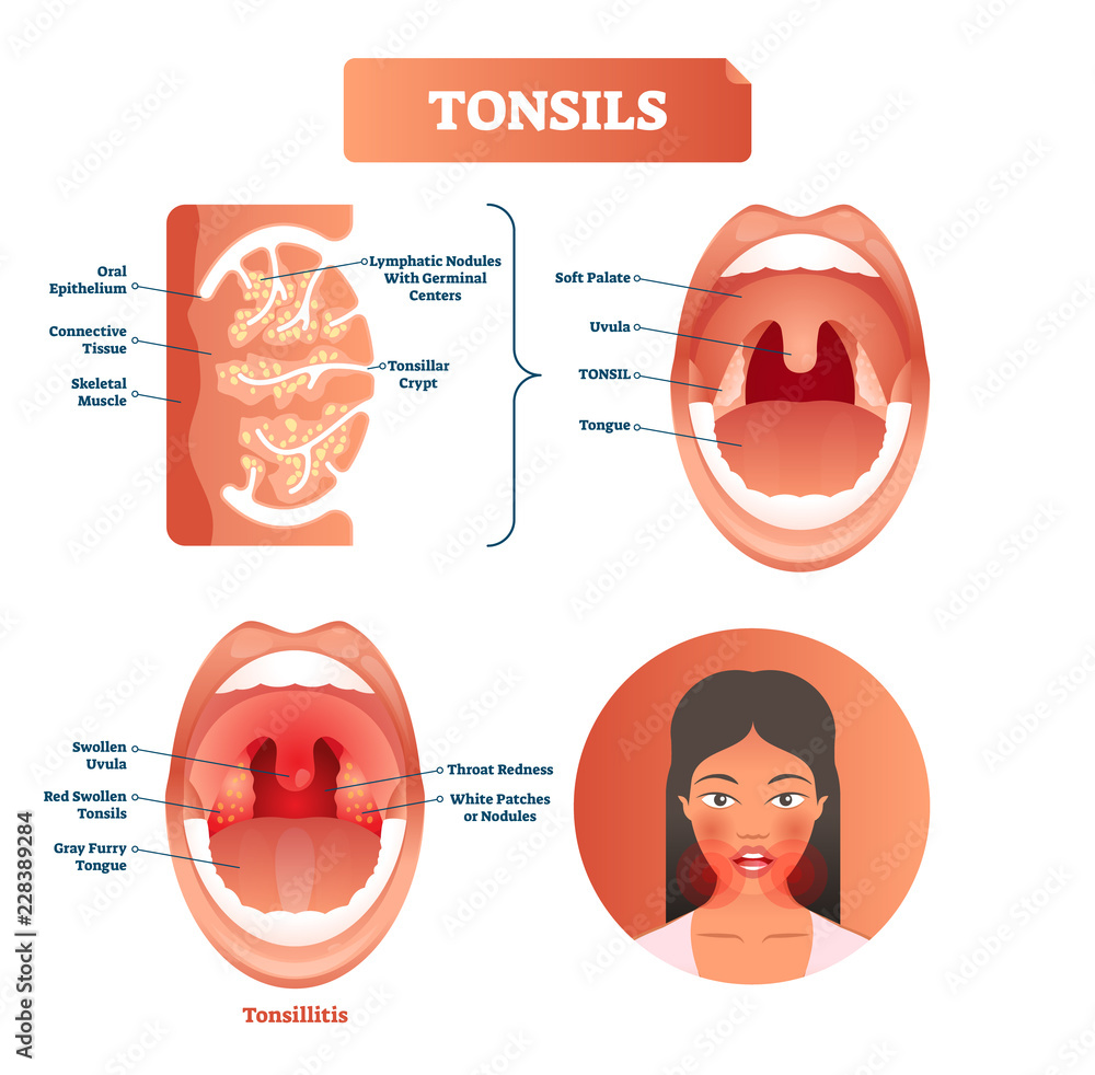 Tonsils vector illustration. Tonsillitis labeled structure diagram ...