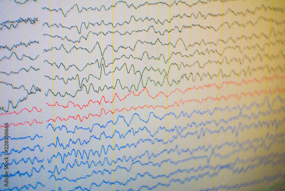 Foto de Computer monitor showing electrical activity of abnormal brain ...