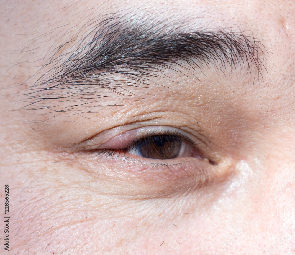 Sore Red Eye. Chalazion and Blepharitis. Inflammation Stock Photo ...