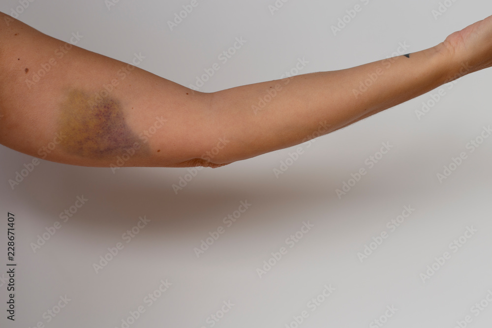 Bruise On Arm