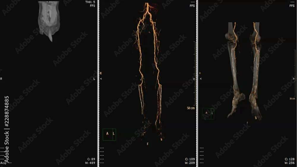 computed tomography angiography, CTA of lower extremity , CTA femoral ...