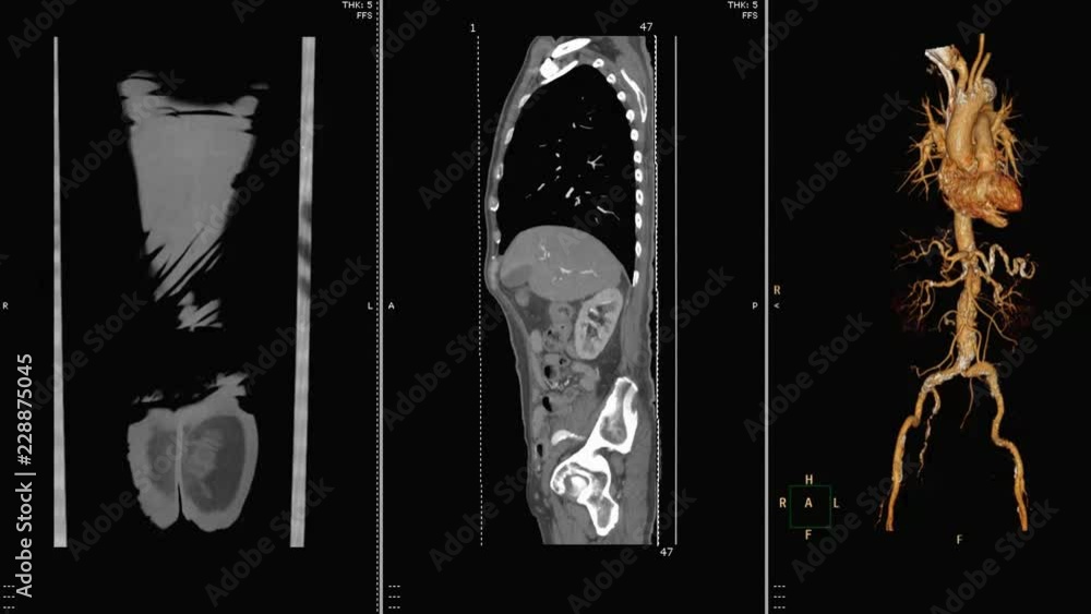 CT scan / CTA abdominal aorta Axial plane , sagittal plane and 3D ...