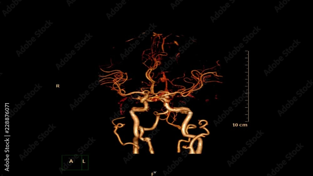 computed tomography angiography, CTA of the brain, 3D Rendering image ...