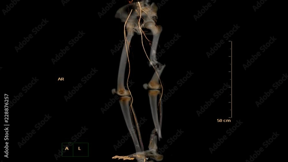 CTA femoral artery run off 2D and 3D rendering image of lower Extremity ...