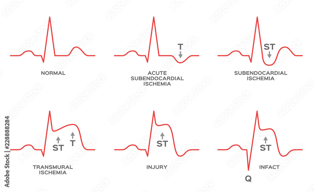 Acute Coronary Syndrome DETAILED Overview (MI, STEMI,, 49% OFF