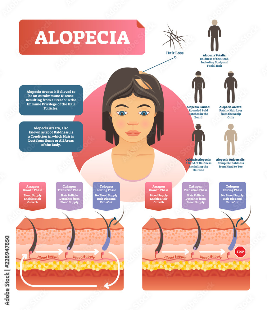 Alopecia Hair Loss Autoimmune Disease Medical Vector Diagram