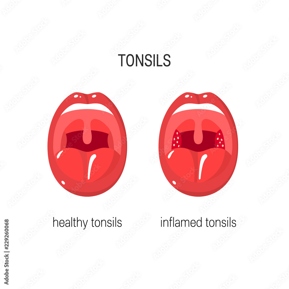 Tonsils vector illustration Stock Vector | Adobe Stock