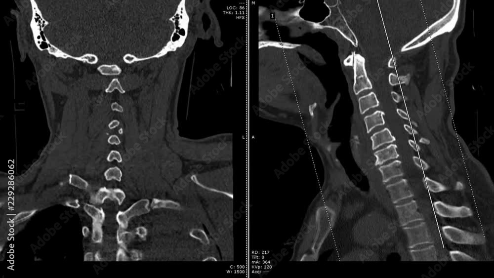 CT SCAN of Cervical Spine ( C-spine ) patient trauma case , Coronal and ...