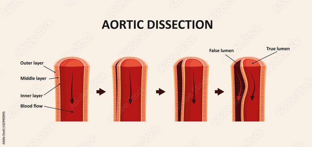 Aortic Dissection, Aortic Aneurysm Stock Vector | Adobe Stock
