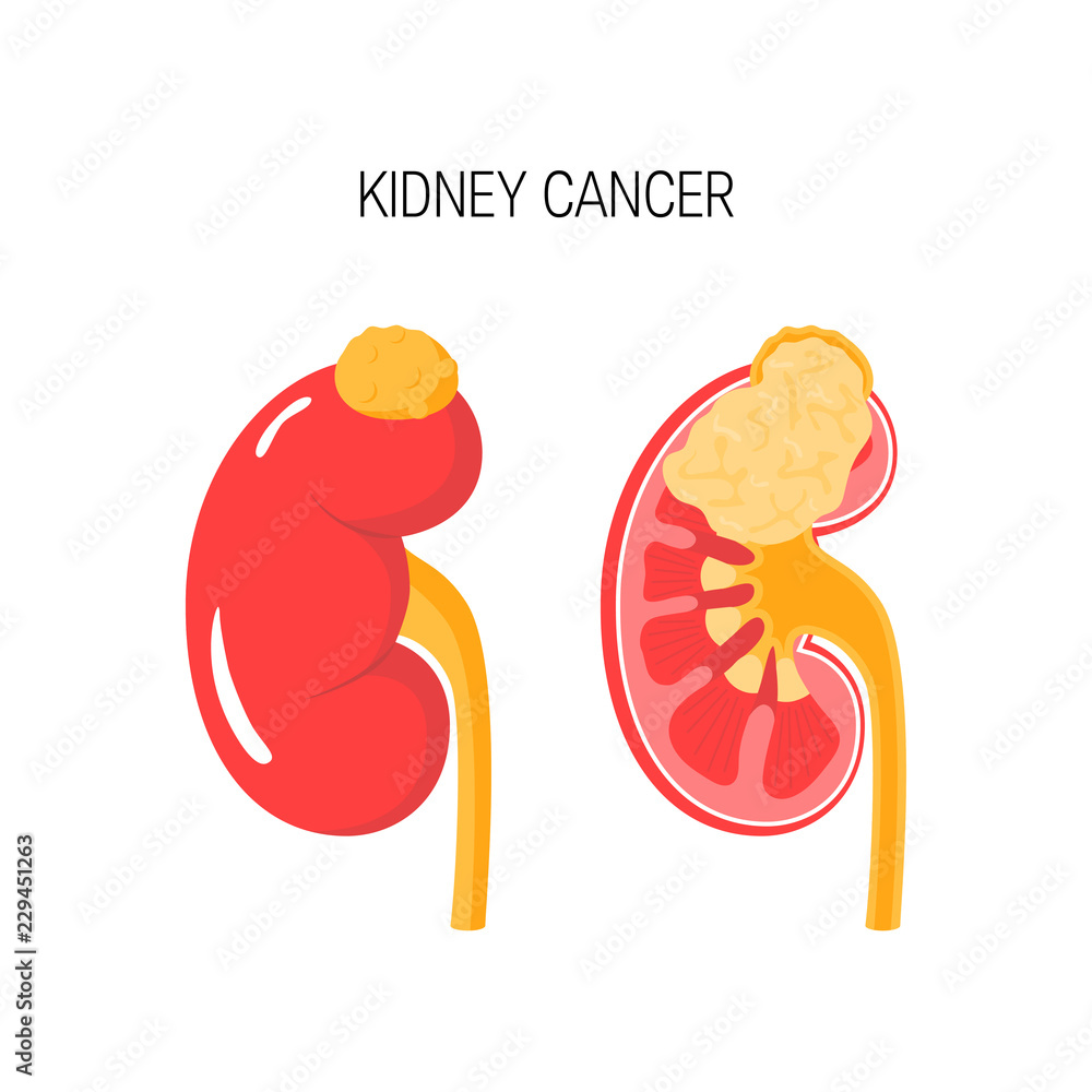 Kidney cancer vector concept Stock Vector | Adobe Stock