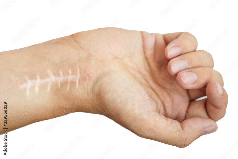 Scar with stitches on the wrist after surgery. Fracture of the bones of ...