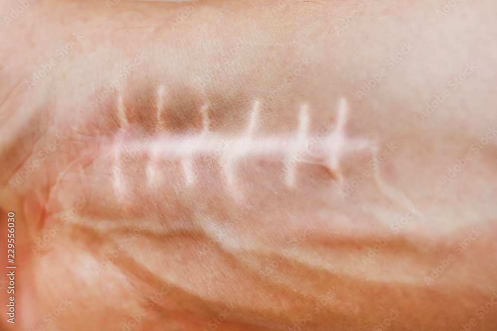 Scar with stitches on the wrist after surgery. Fracture of the bones of ...