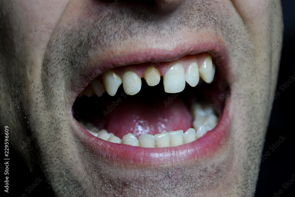 The process of replacing a tooth. Preparation of the tooth under the ...