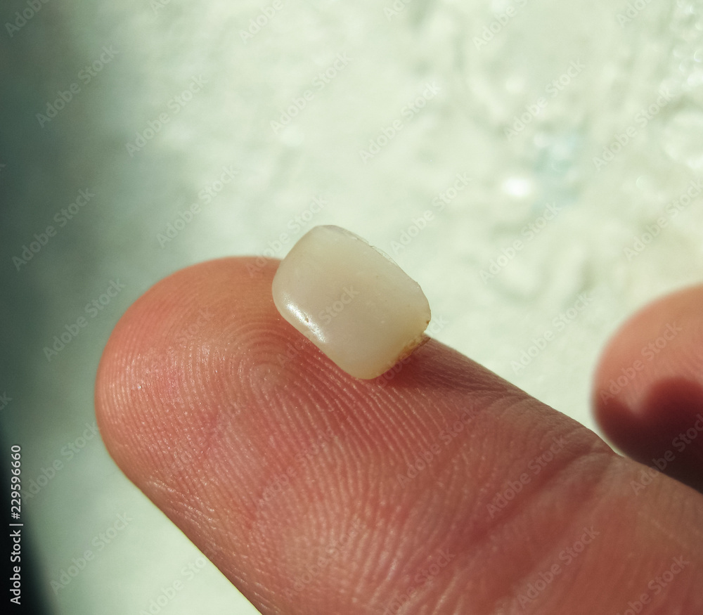 Fallen off old filling with a cutter. The seal of the tooth Stock Photo ...