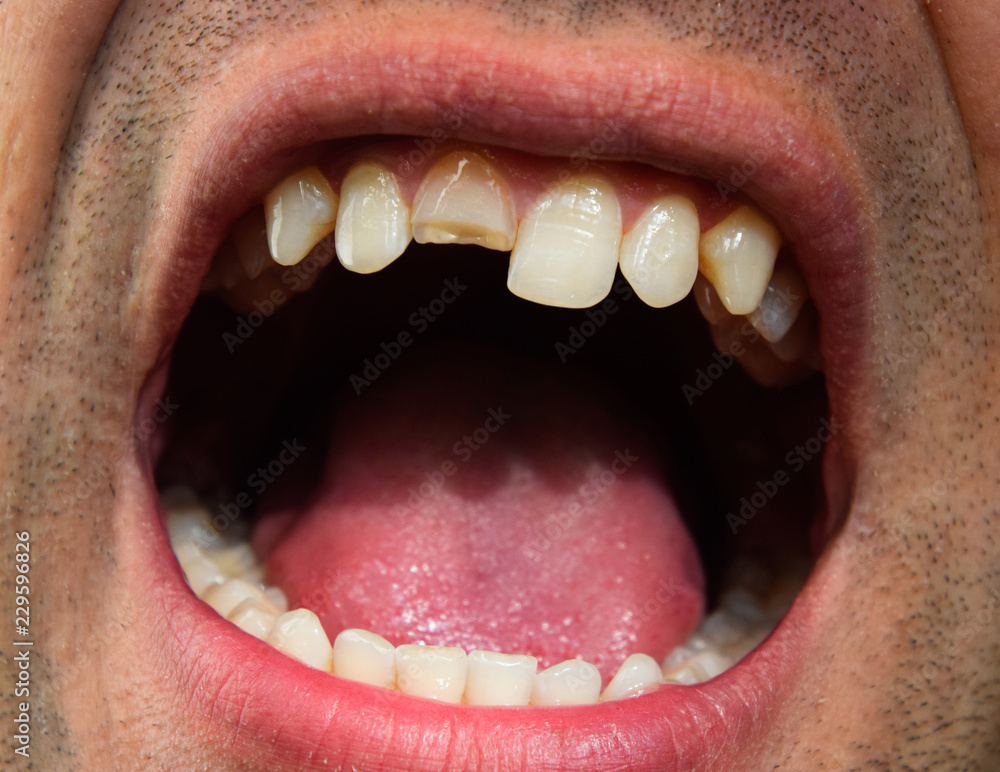 Broken tooth. Broken upper incisor in a man mouth. Man shows oral ...