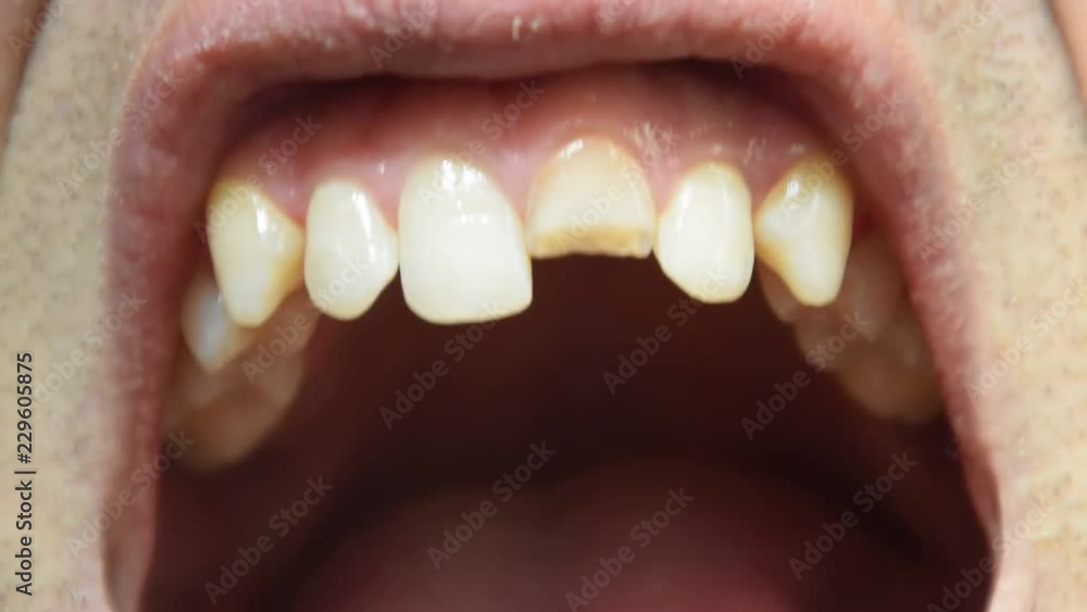 Broken tooth. Broken upper incisor in a man mouth. Man shows oral ...