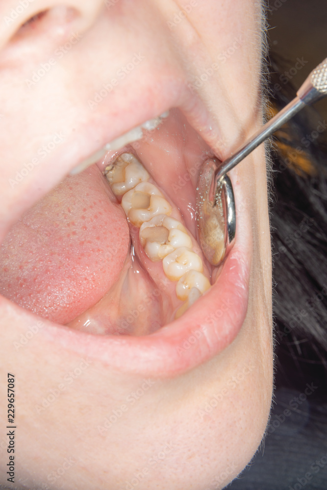 two chewing side teeth of the upper jaw after treatment of caries ...