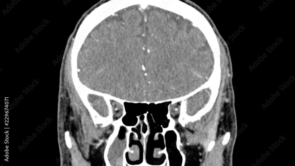 Vídeo do Stock: Tomography of a unaffected healthy human brain live ...