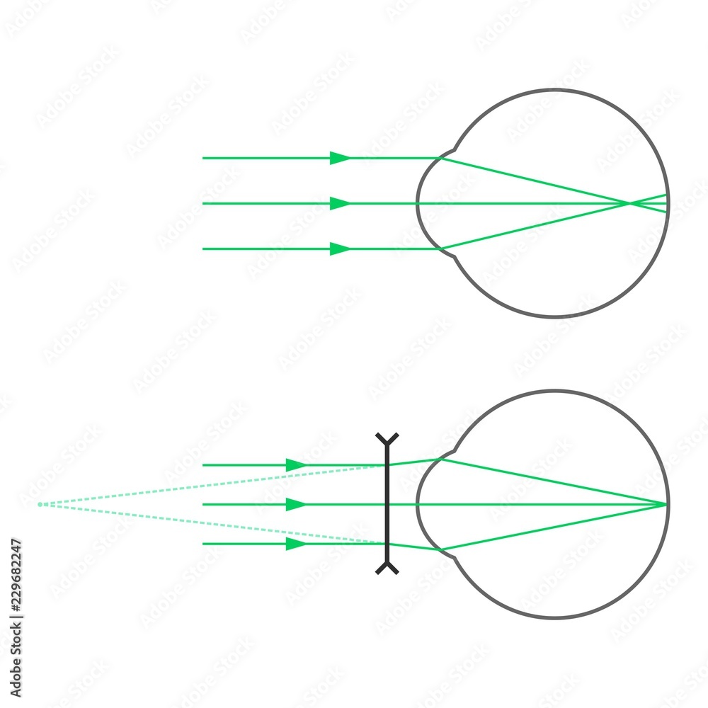 Myopia (nearsightedness) and myopia correction with glasses Stock ...