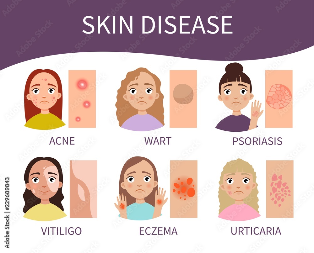 Infographics skin diseases. illustration of cute girls Stock Vector ...
