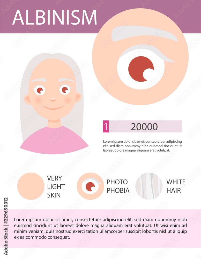 Infographics of albinism Stock Vector | Adobe Stock