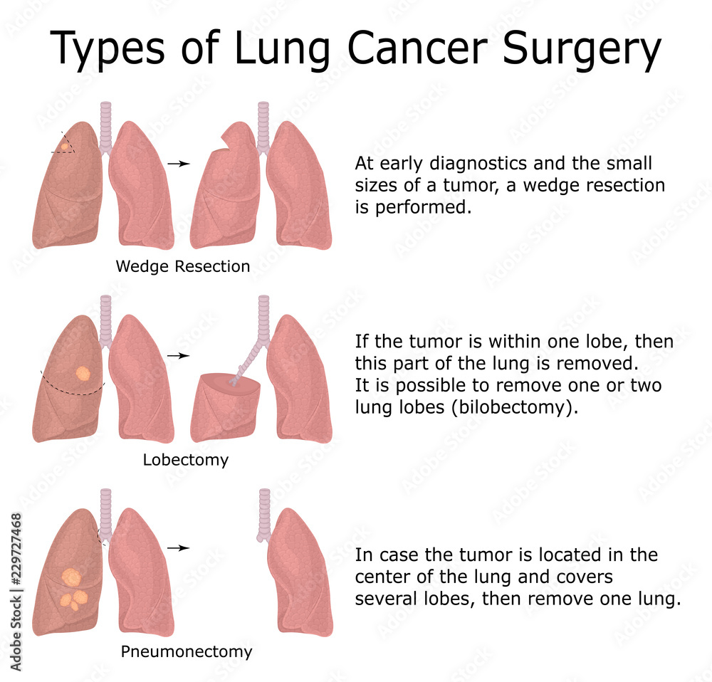 Types Of Lung Cancer Surgery Stock Vector Adobe Stock