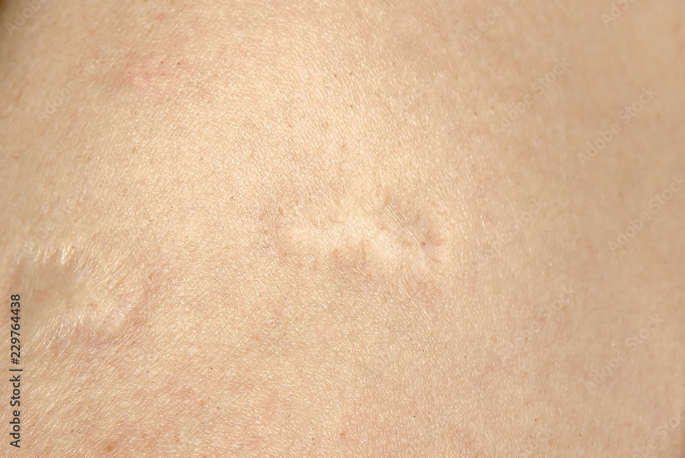 Chickenpox Vaccine Scar