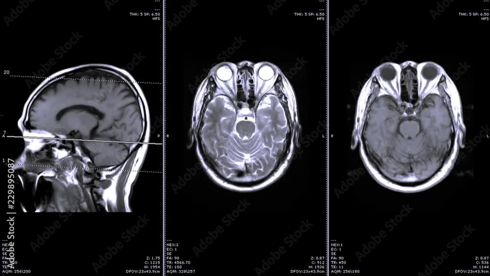 MRI of the brain sagittal and Coronal plane comparison. Medical ...