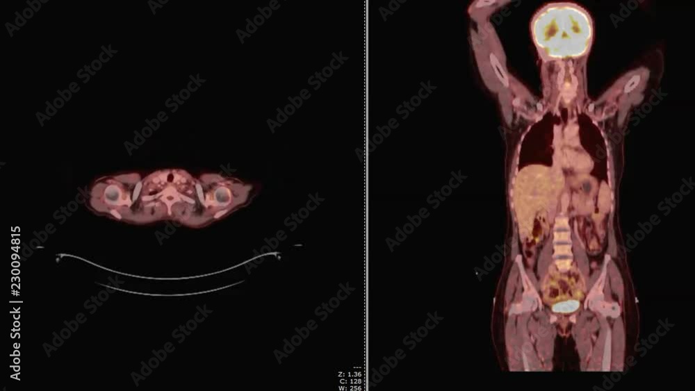 Positron Emission Tomography - Computed Tomography ( PET/CT ) axial ...