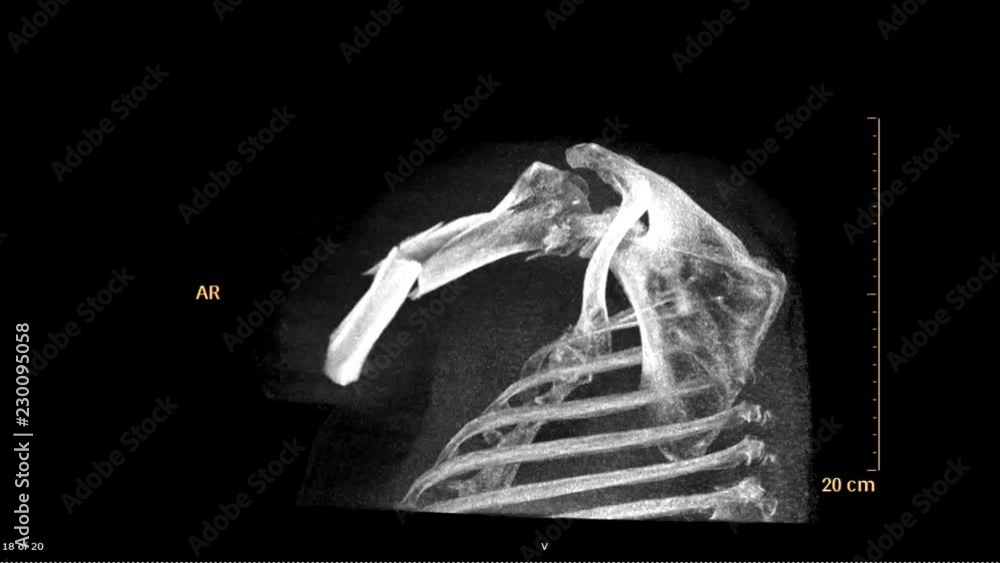 CT scan 3D rendering image of Left shoulder use Maximum intensity ...