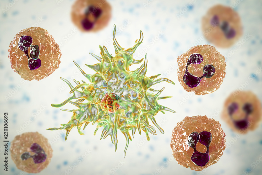 Cerebrospinal fluid smear containing amoeba Acanthamoeba and ...