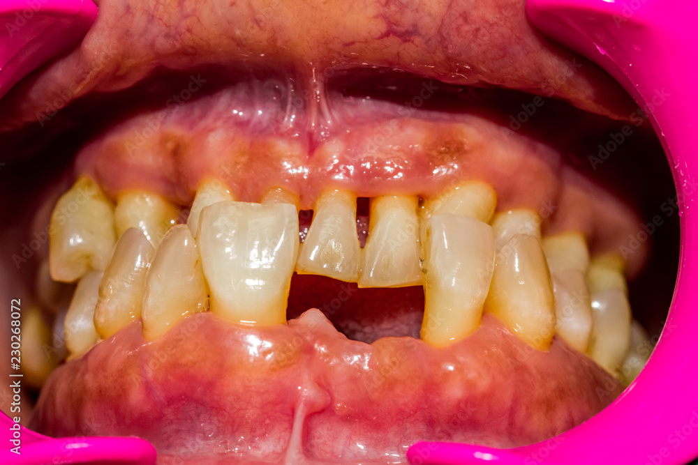 Close up human patient open mouth showing caries teeth decay with ...