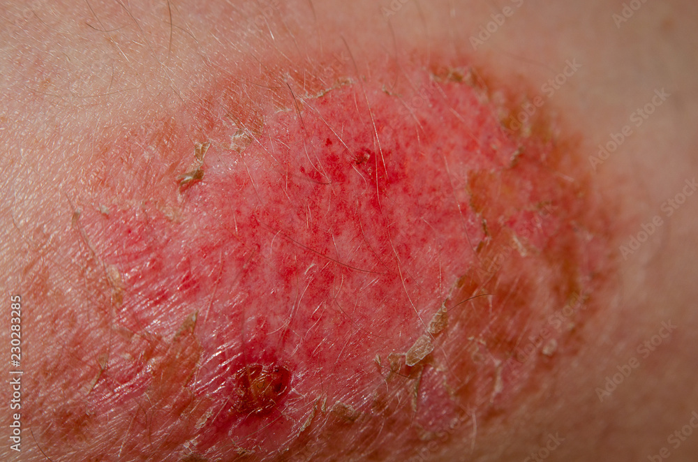 Wound after burn on human body Stock Photo | Adobe Stock