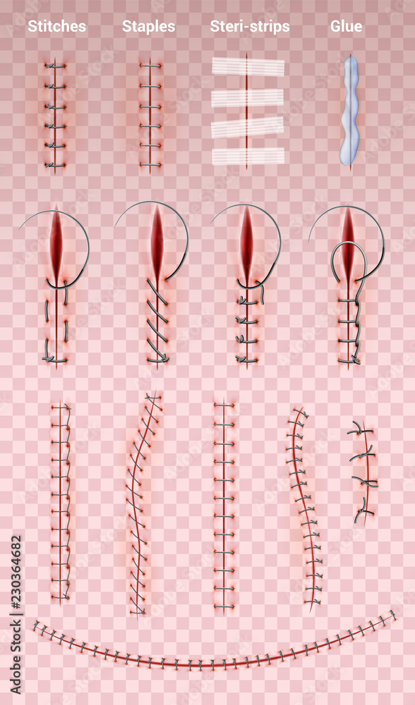 Surgical Suture Stitches Set Stock Vector | Adobe Stock