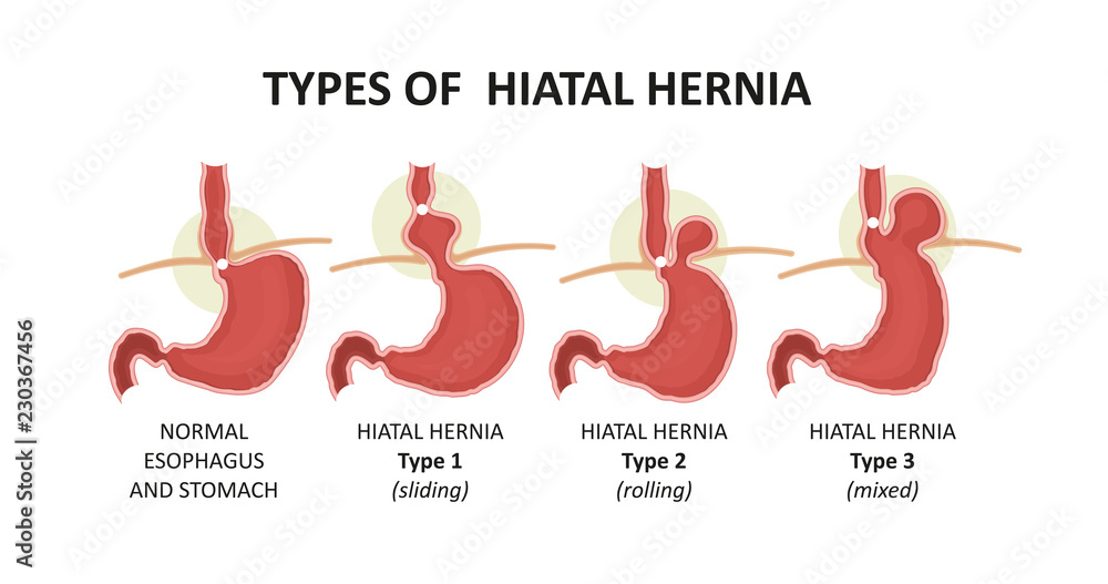 Póster types of hiatal hernia – Cuadro para Pared | Posters.es