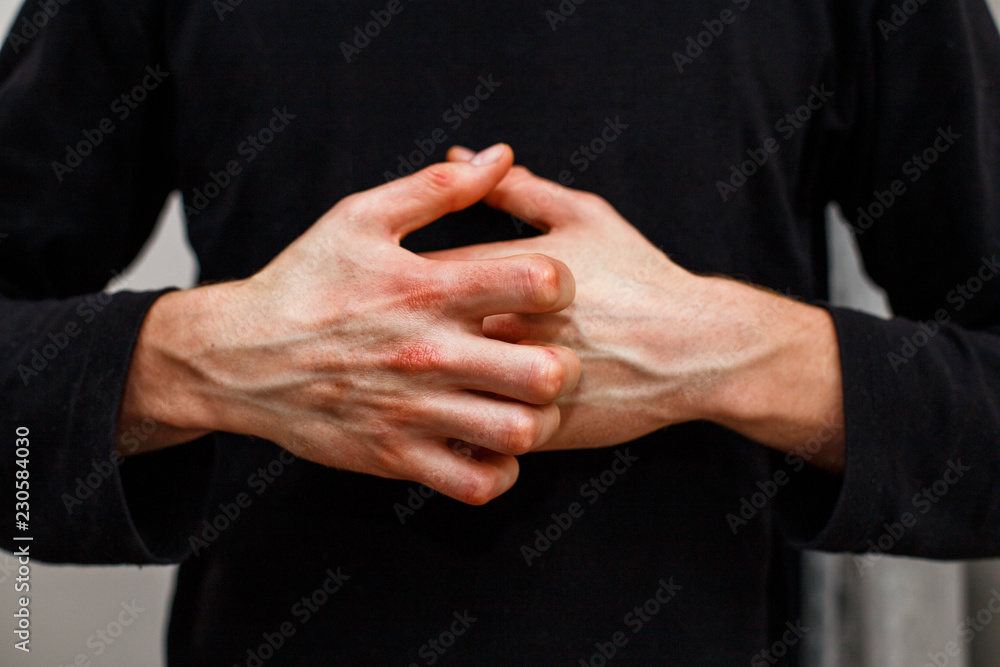 Man scratch oneself, dry flaky skin on hand with psoriasis vulgaris ...