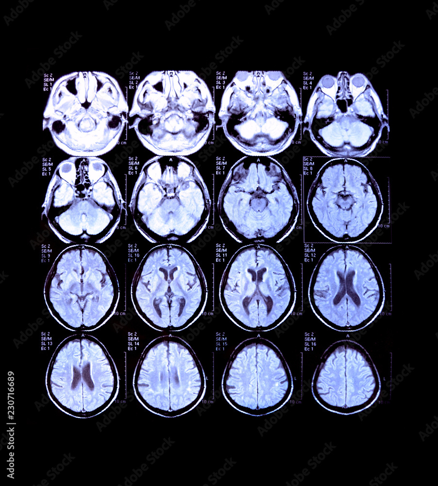 Radiograph Neuroimaging of Brain - Head Medical Monitoring - Xray, MRI ...