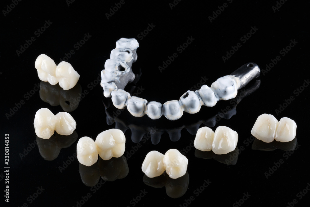 titanium beam and manufactured high-quality crowns, all set for an all ...